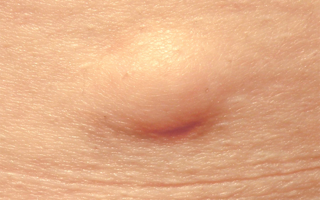 Surgical Dermatology – Derma Care Clinic